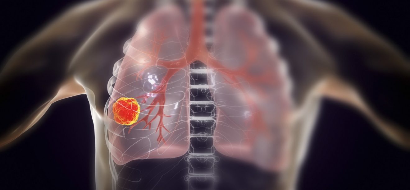 Cancer pulmonar: Primele semne apar chiar la mâini - Exquis